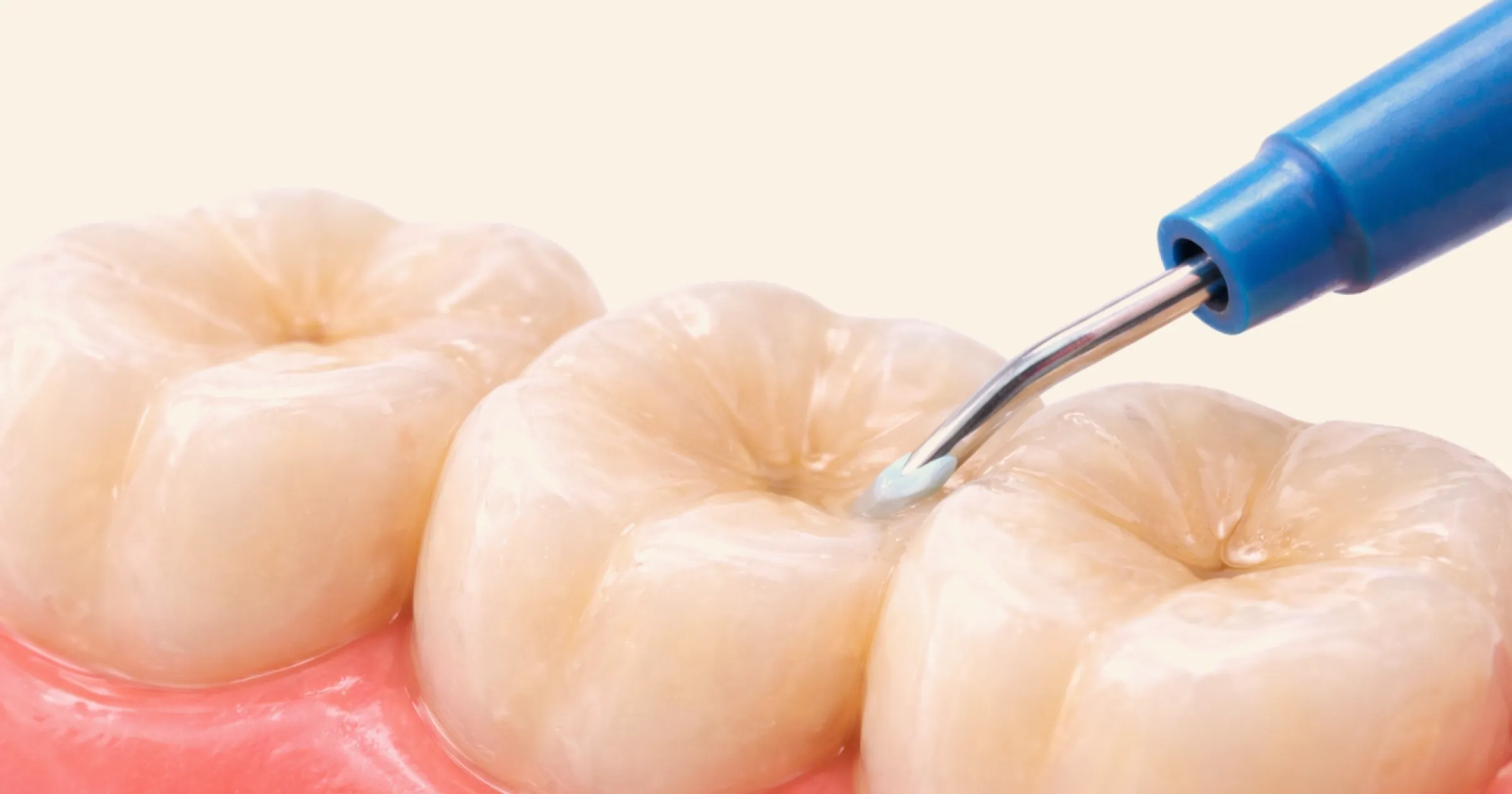 Composite Filling Near Me UK | Private Dental White Fillings for Teeth ...